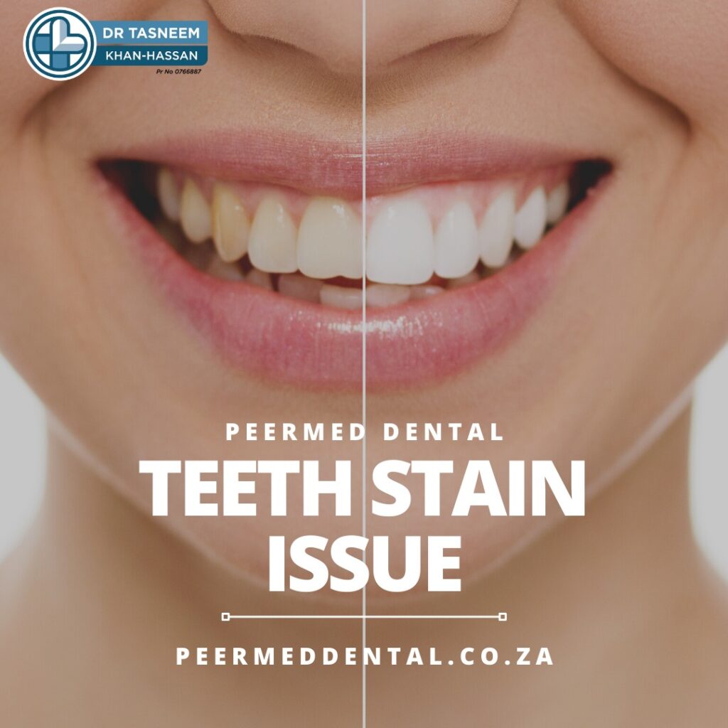 EXTRINSIC TOOTH STAIN - Peermed Dental Benoni