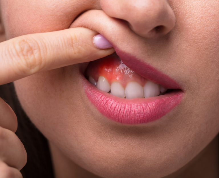 Gum Infection Symptoms - Peermed Dental Benoni