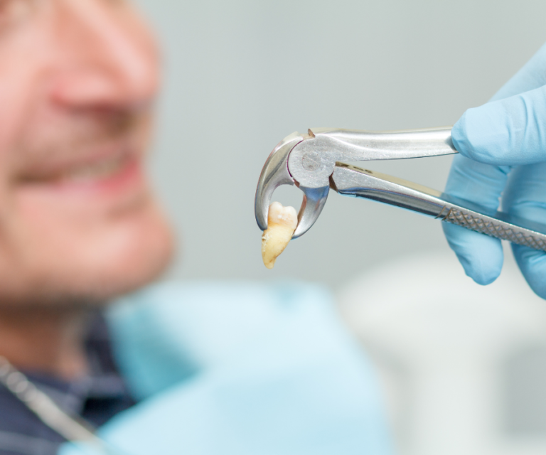 All You Need to Know About Tooth Extractions - Peermed Dental Benoni